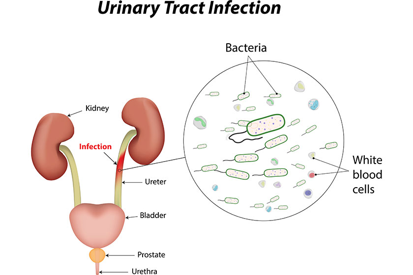 The Risks Of UTIs As You Age - Discovery Village
