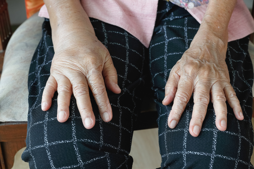 How To Treat Edema While Residing Assisted Living Facilities In Palm ...